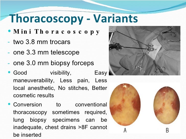 Medical Thoracoscopy