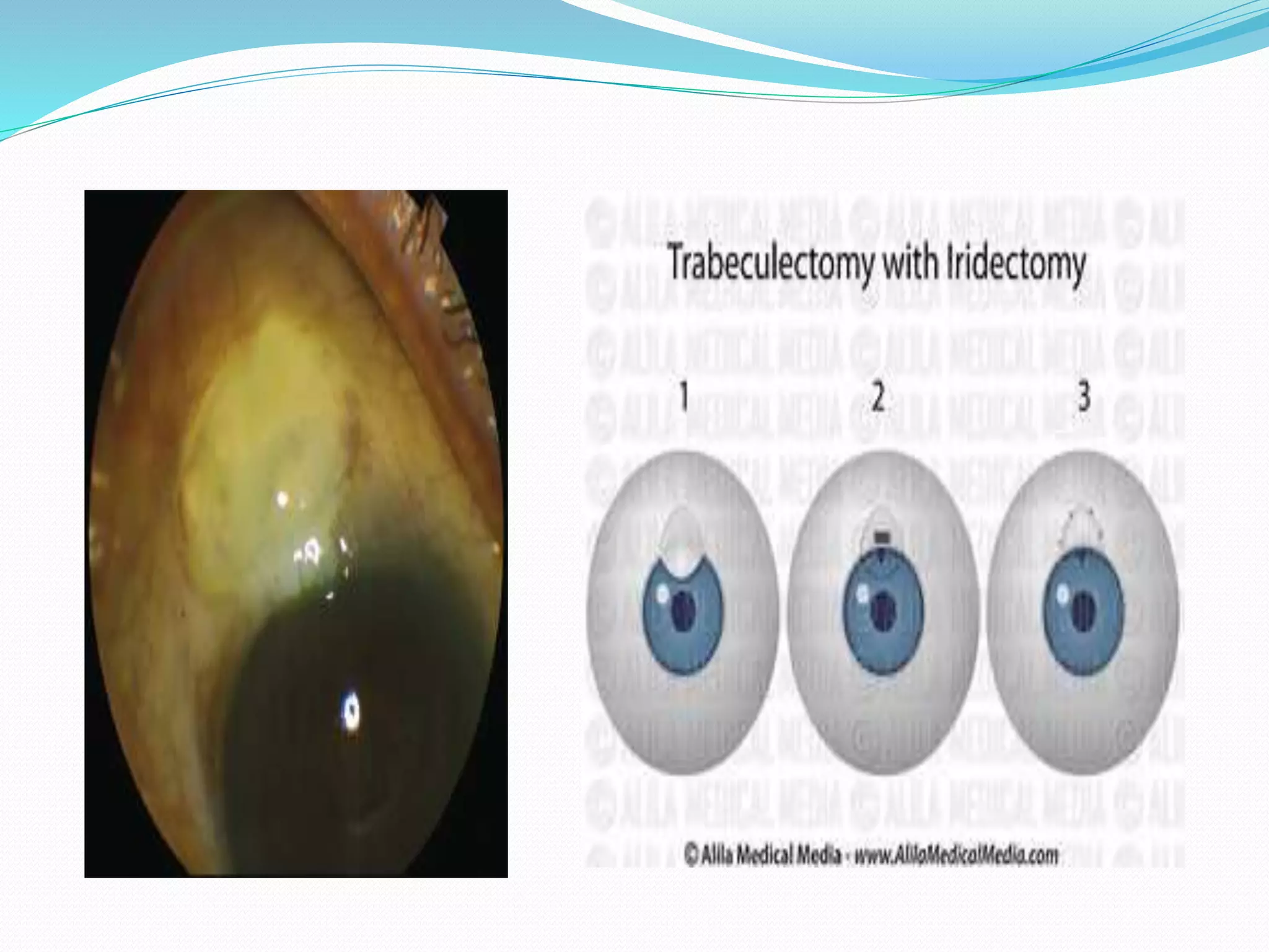 Medical treatment of primary open angle glaucoma | PPTX | Eye and ...