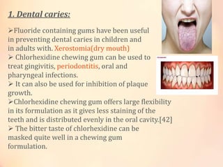 Medicated chewing gums-A glimpse | PPT