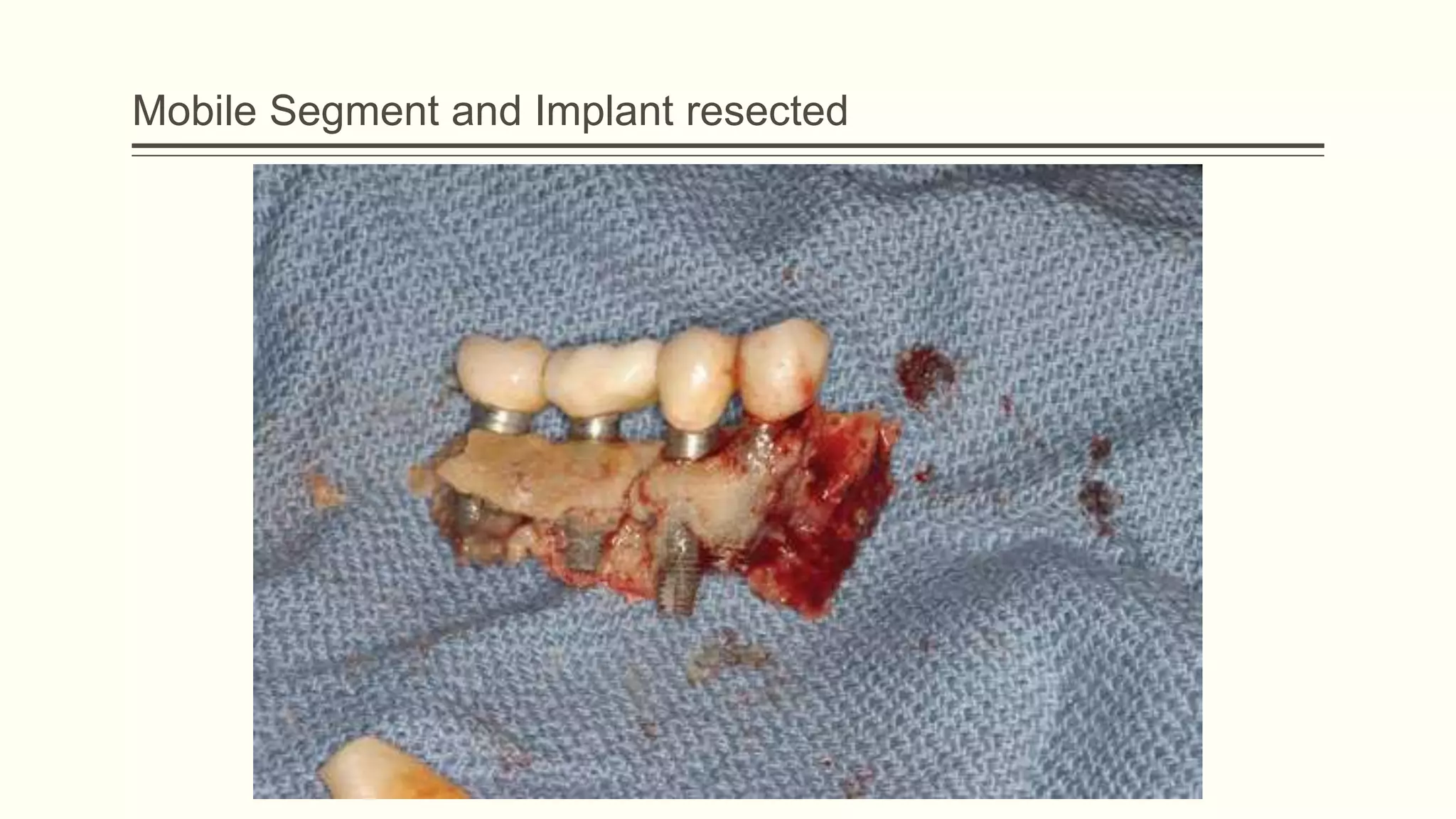 Medication-Related Osteonecrosis of the jaws (MRONJ).pptx