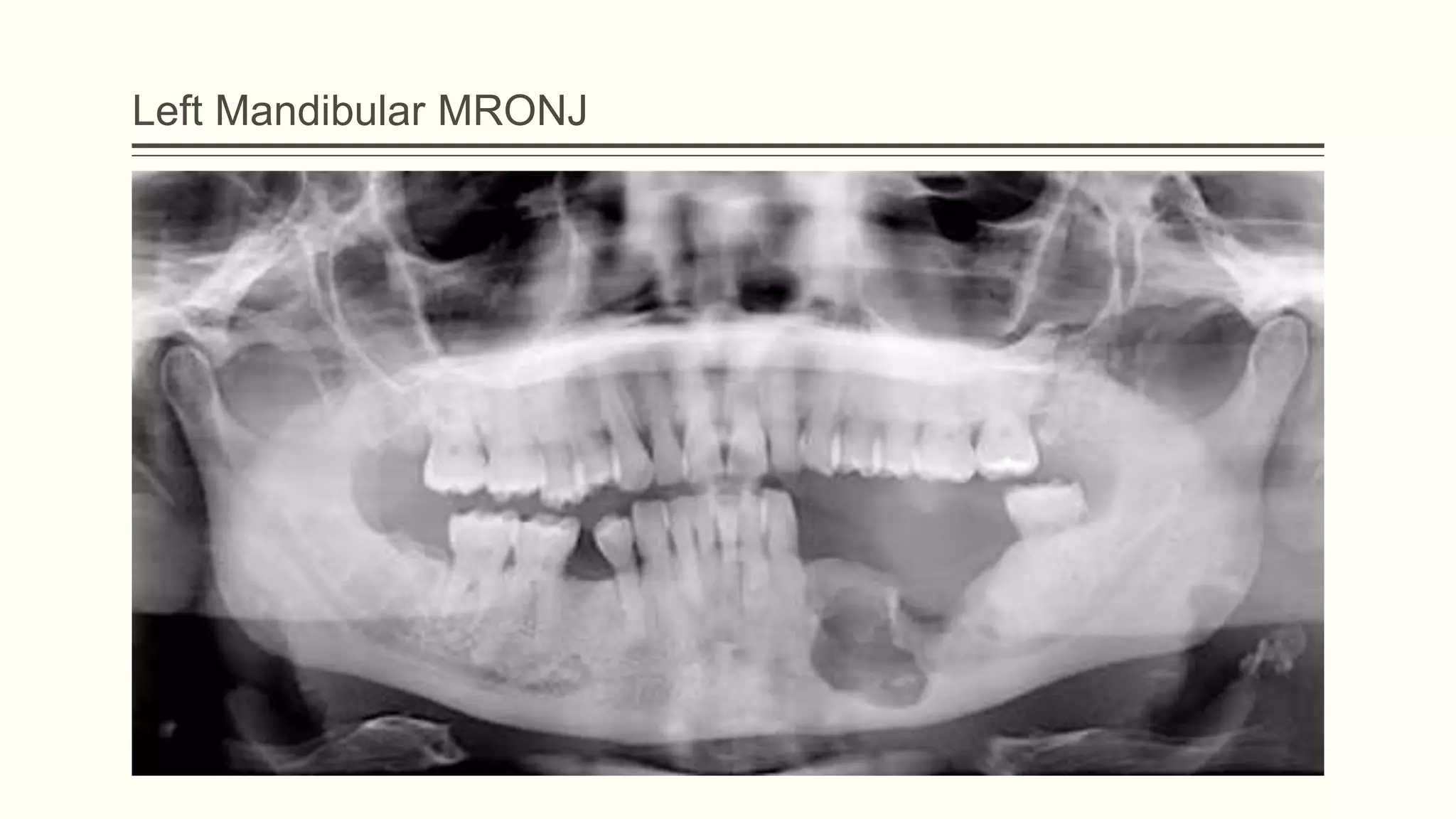 Medication-Related Osteonecrosis of the jaws (MRONJ).pptx