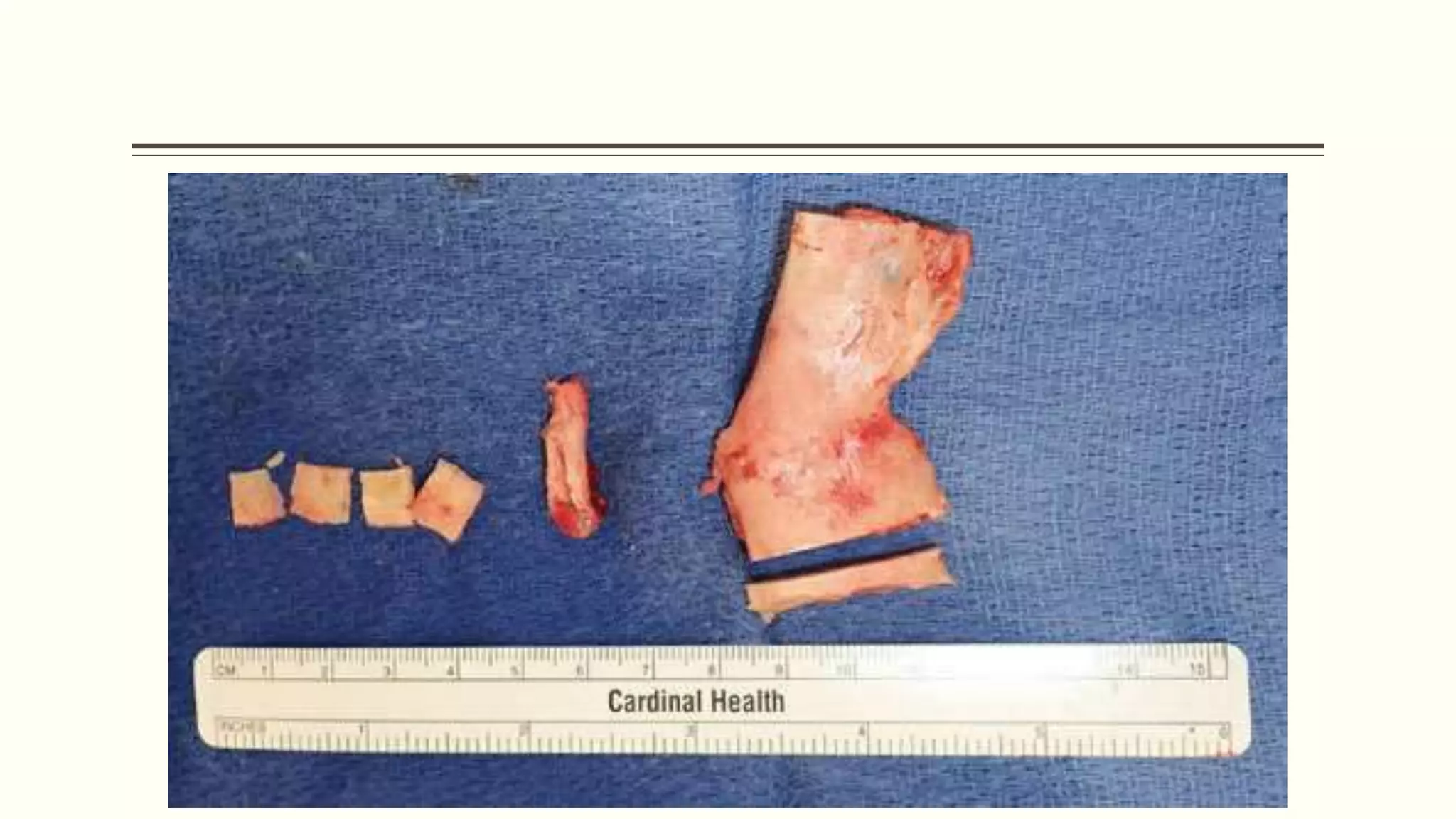 Medication-Related Osteonecrosis of the jaws (MRONJ).pptx