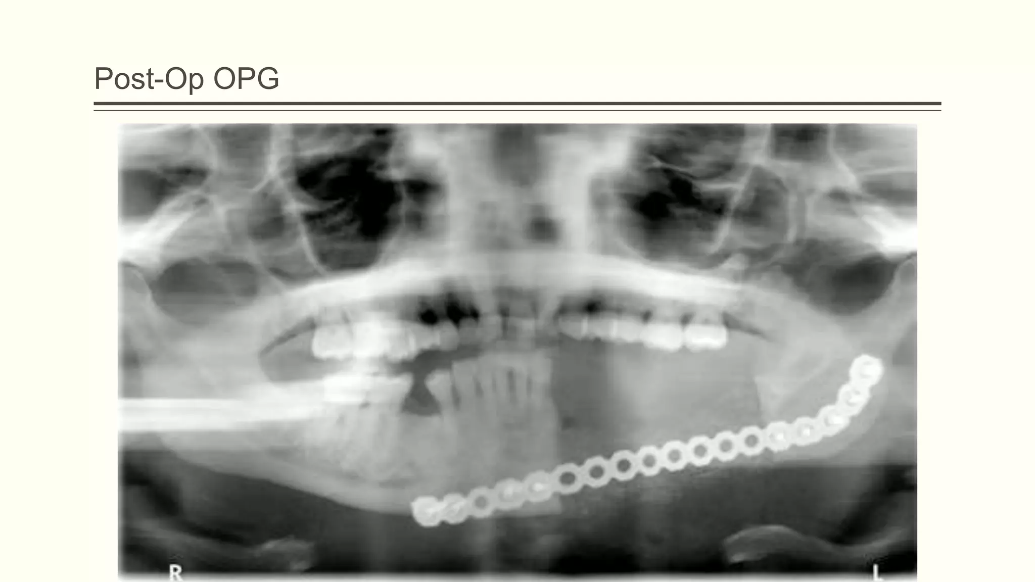 Medication-Related Osteonecrosis of the jaws (MRONJ).pptx