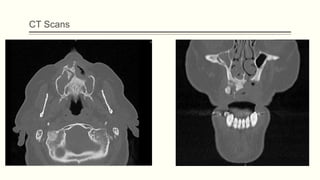 Medication-Related Osteonecrosis of the jaws (MRONJ).pptx