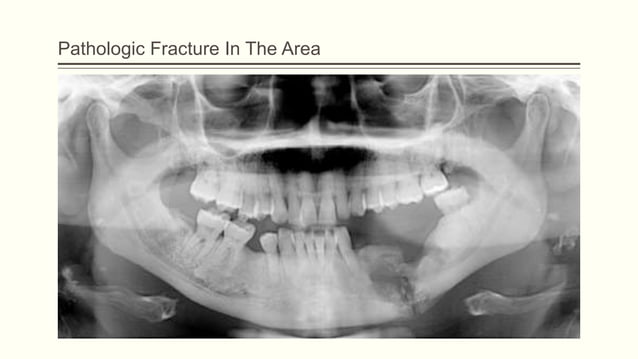 Medication-Related Osteonecrosis of the jaws (MRONJ).pptx