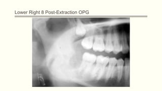Medication-Related Osteonecrosis of the jaws (MRONJ).pptx
