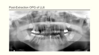 Medication-Related Osteonecrosis of the jaws (MRONJ).pptx