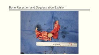 Medication-Related Osteonecrosis of the jaws (MRONJ).pptx