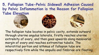 Medication for Tubal Diseases - Tubal Blockage and Hydrosalpinx | PDF