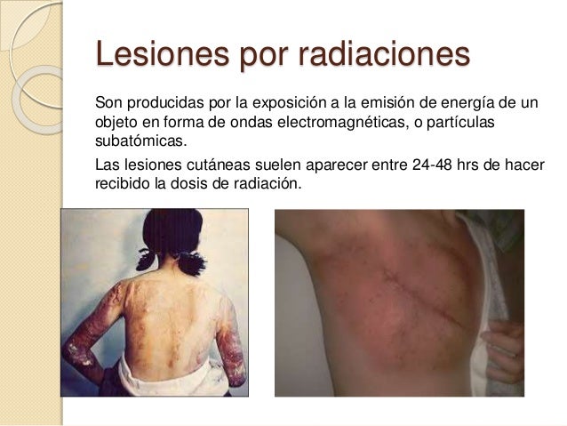 Lesiones Leves