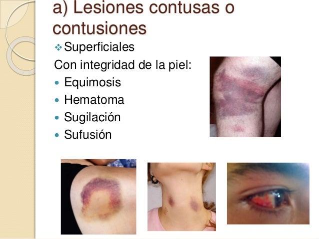 Clasificación legal de las lesiones