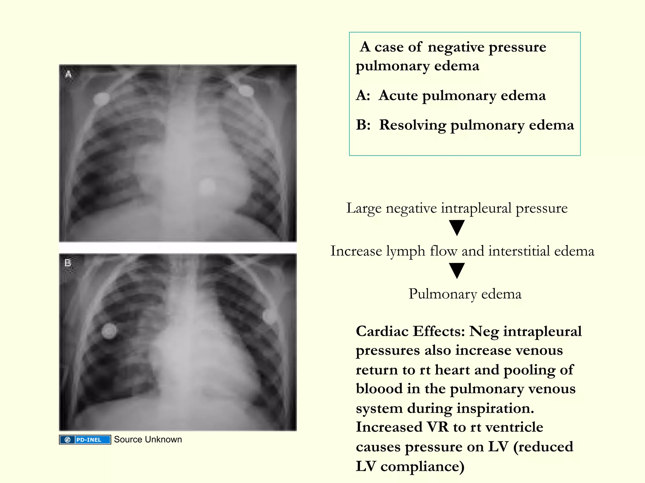 GEMC: Acute Pulmonary Emergencies: Pulmonary Embolism, Pulmonary Edema ...