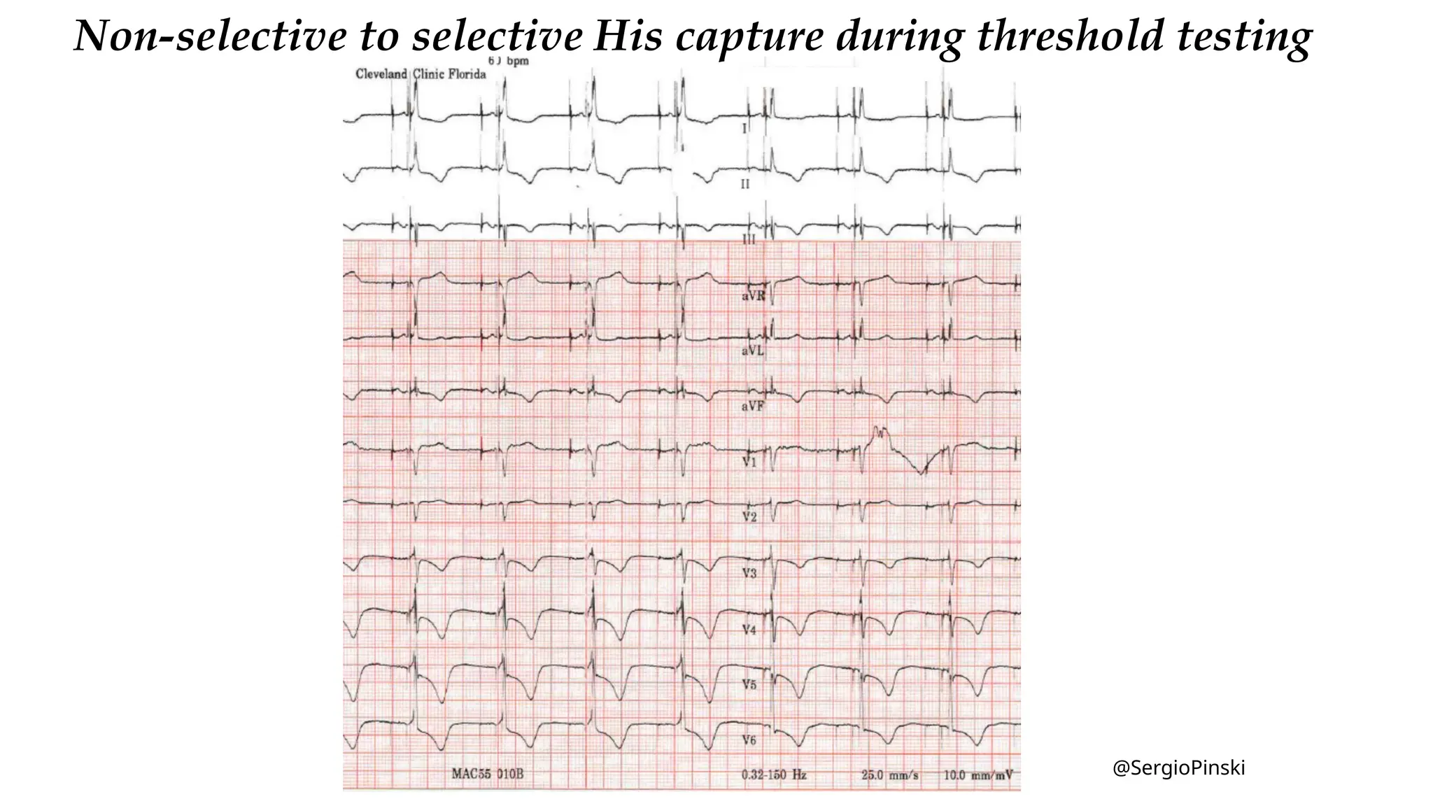 Review Of Conduction System Pacing Pptx