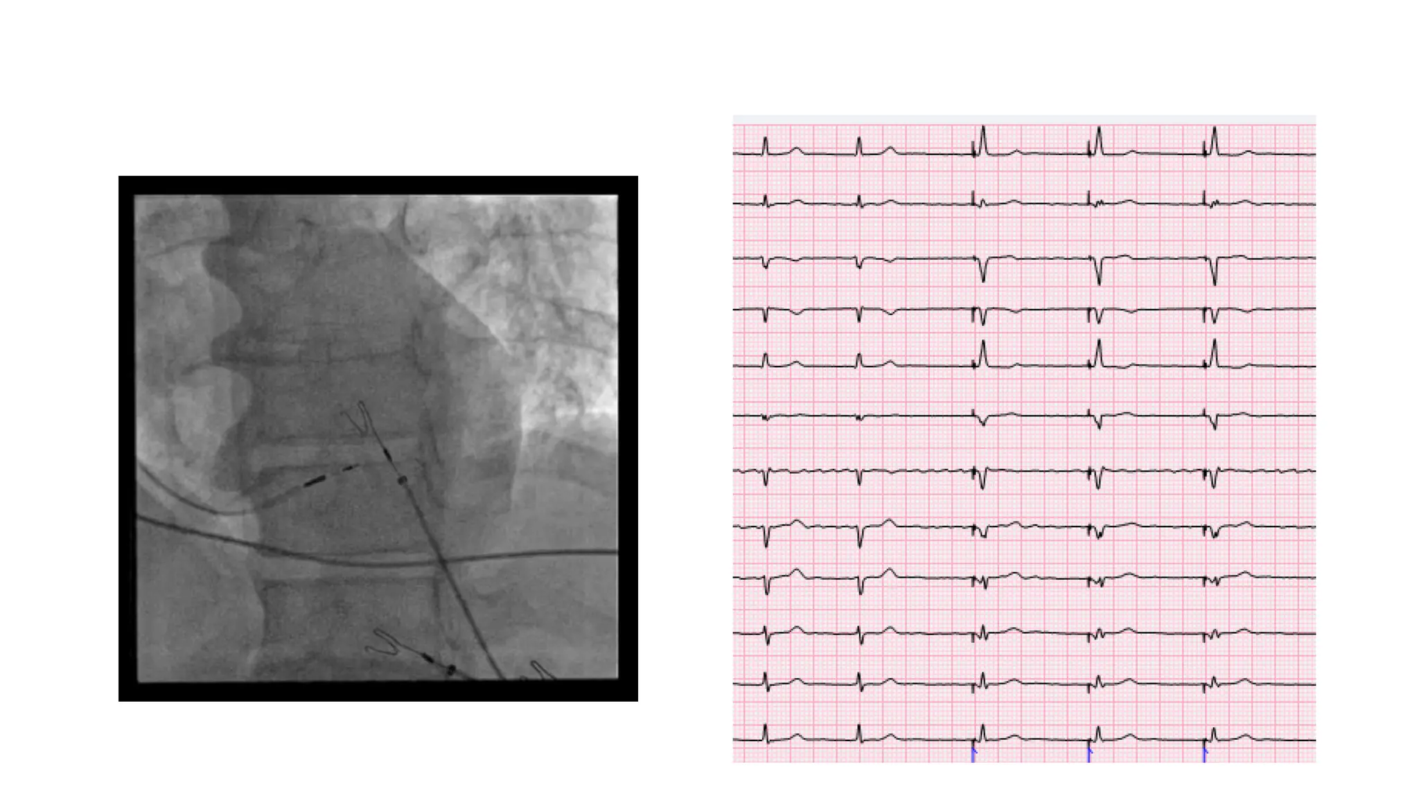 Review Of Conduction System Pacing Pptx