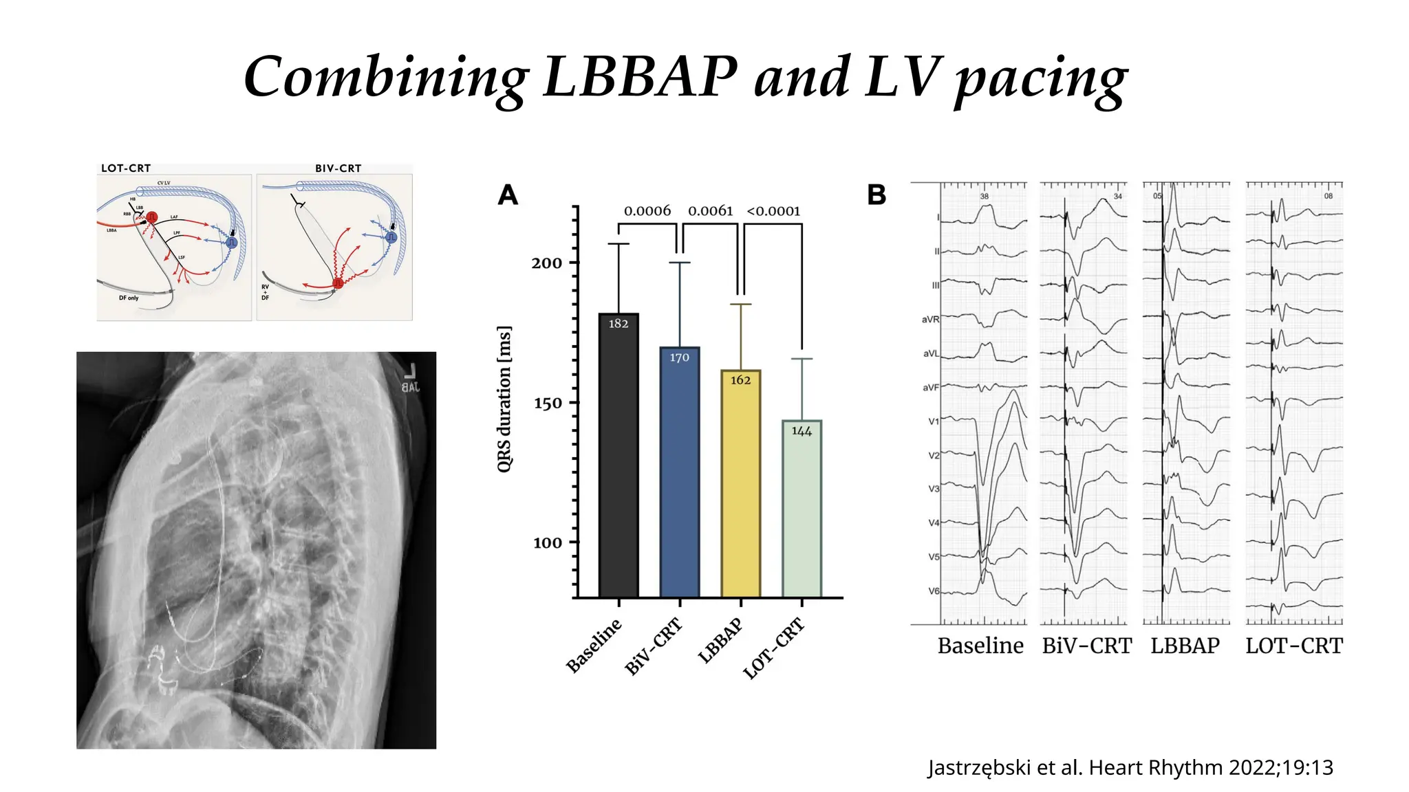 Review Of Conduction System Pacing Pptx