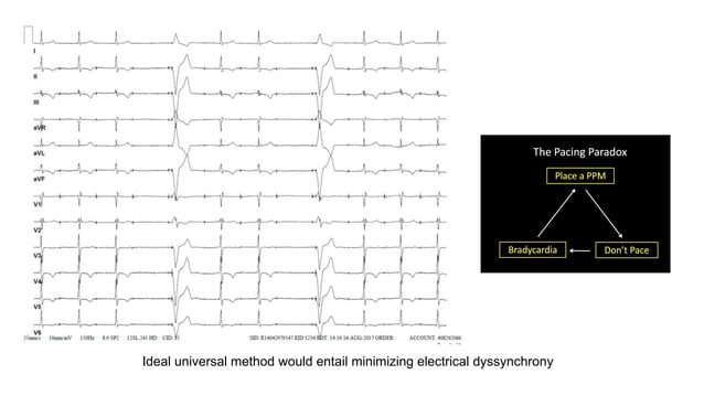 Review of conduction system pacing | PPTX
