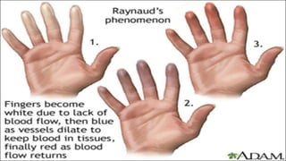 Raynauds phenomena | PPTX