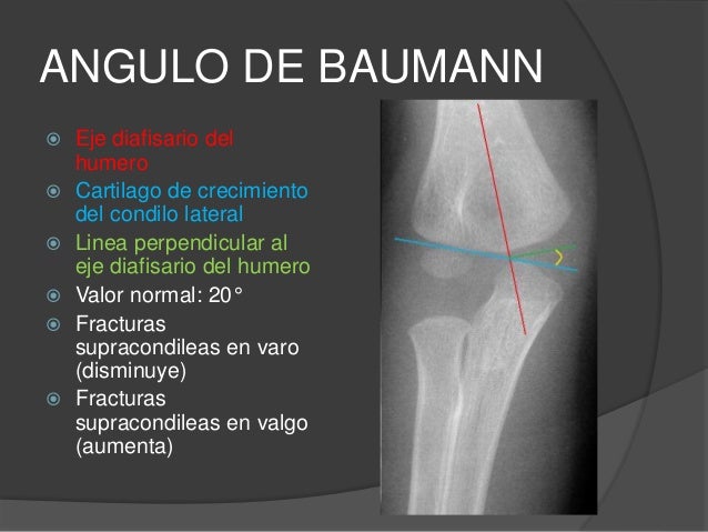 Mediciones radiograficas codo