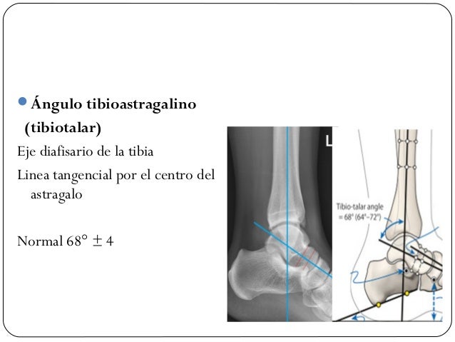 Mediciones Radiográficas de Tobillo