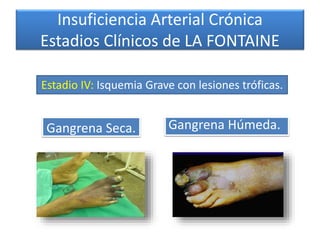 SVS - iac - clasificacion de Varices | PPTX