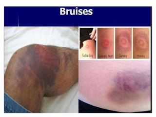 medico legal aspects of wound - forensic medicine | PPTX