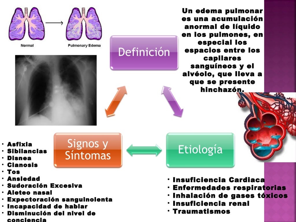 Edema Pulmonar y Acciones de Enfermeria