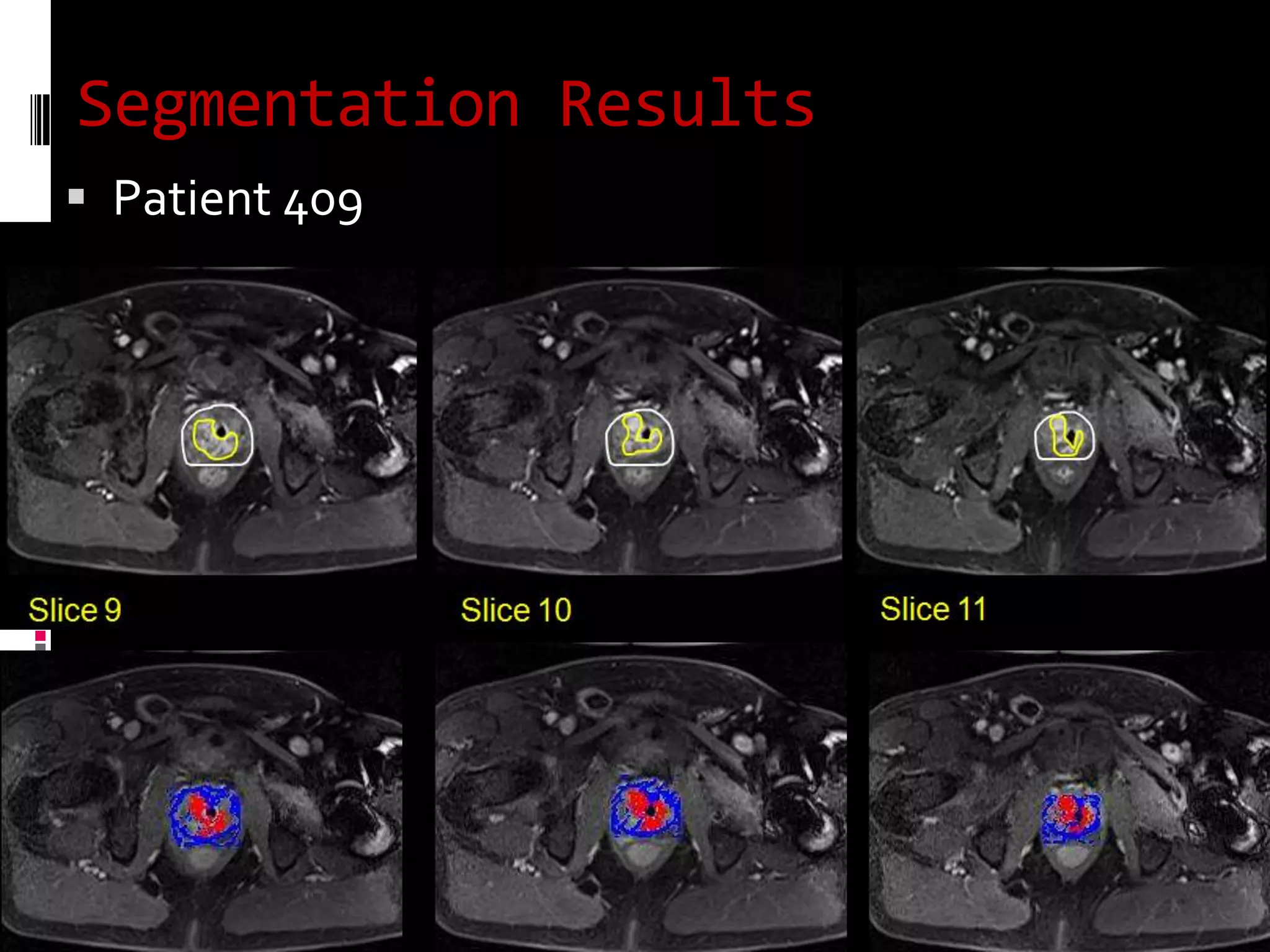 Post-Processing of Prostate Perfusion MRI | PPT