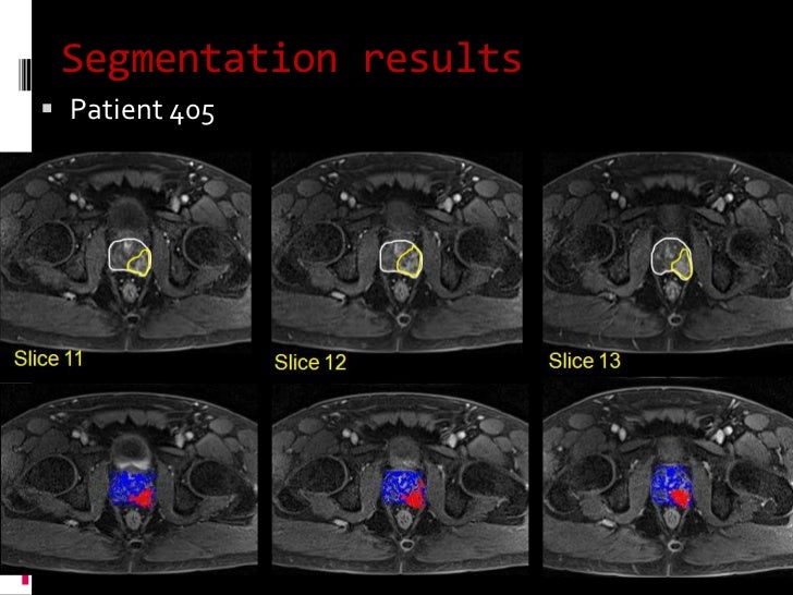 Post-Processing of Prostate Perfusion MRI