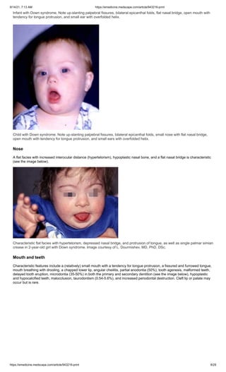 Down Syndrome (Medscape.com) | PDF