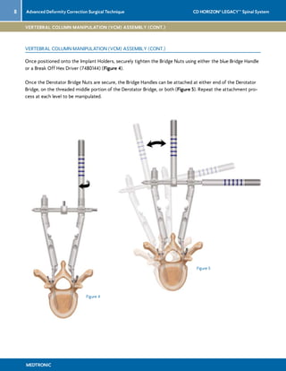 Medtronic cd horizonadvanceddeformityst | PDF