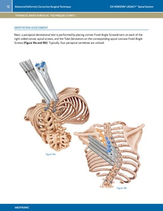Medtronic cd horizonadvanceddeformityst | PDF