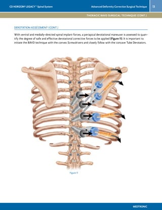 Medtronic cd horizonadvanceddeformityst | PDF