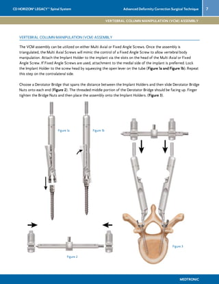 Medtronic cd horizonadvanceddeformityst | PDF