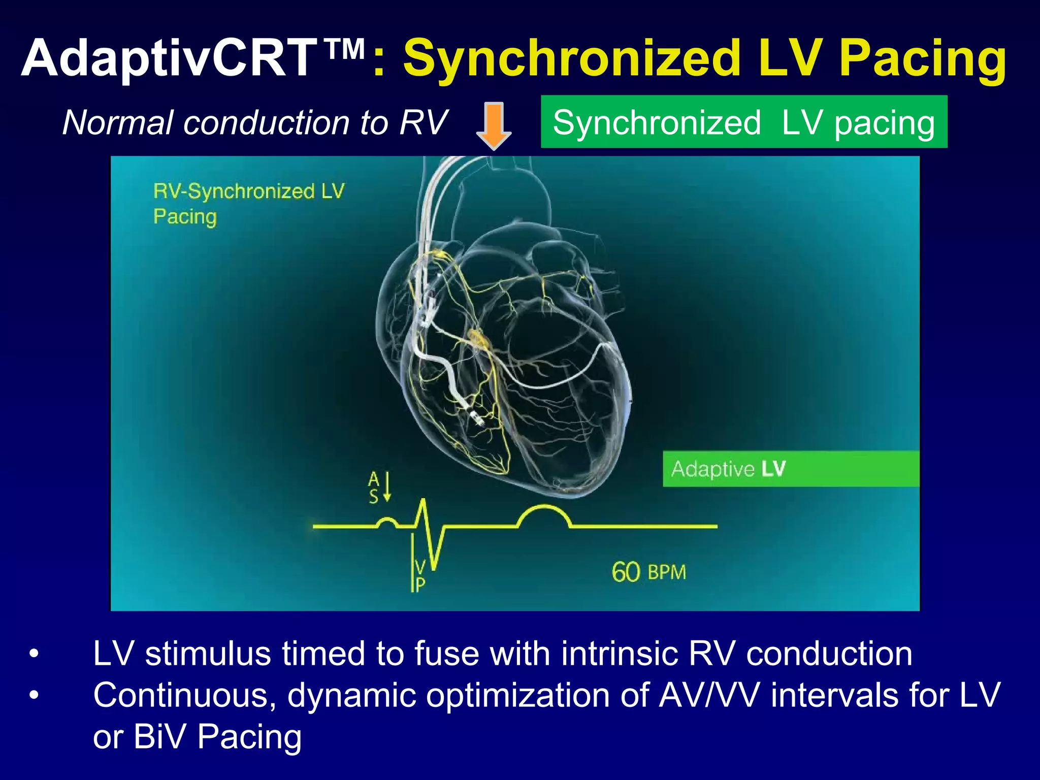 Medtronic international the future of cardiac resynchronisation therapy ...
