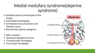 Medial Medullary Syndrome