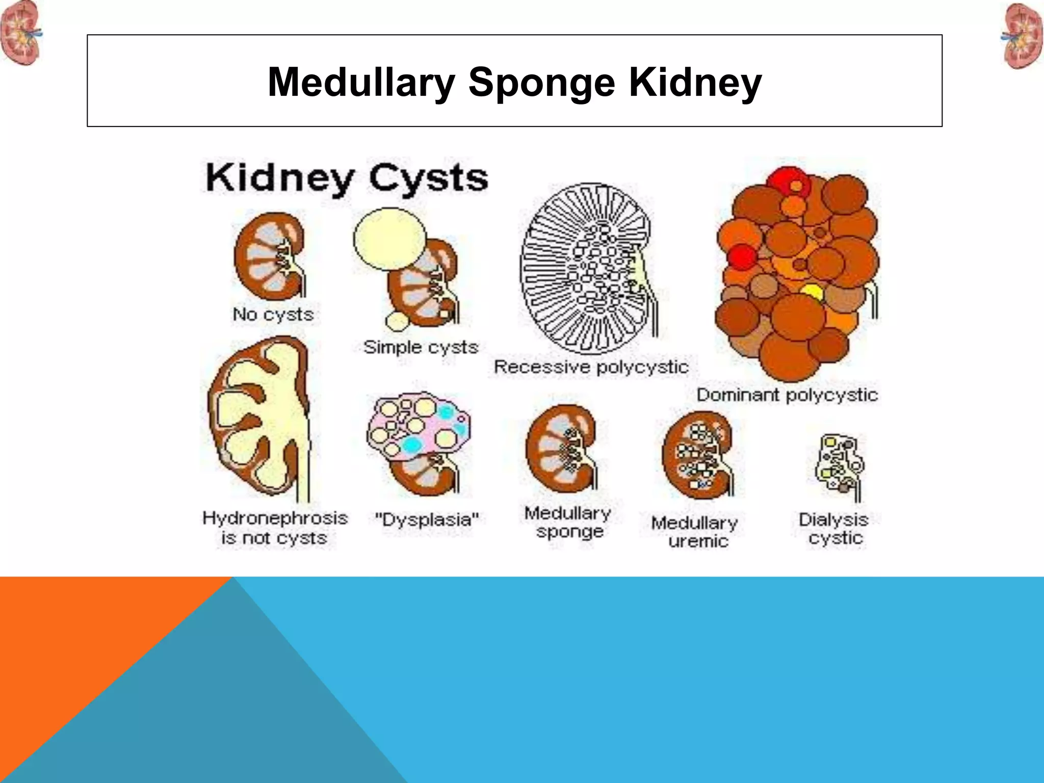 Medullary sponge kidney (msk) | PPTX