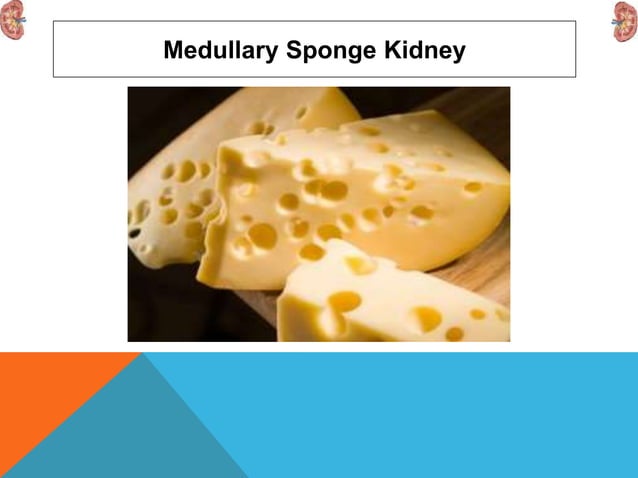 Medullary sponge kidney (msk) | PPTX