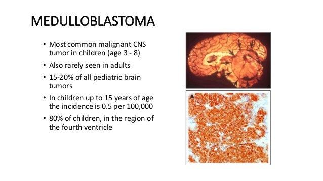 Medulloblastoma