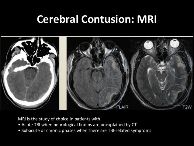 Medulloblastoma