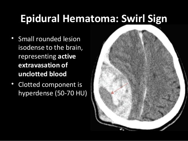 Medulloblastoma