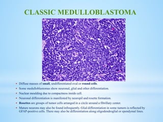 MEDULLOBLASTOMA | PPTX
