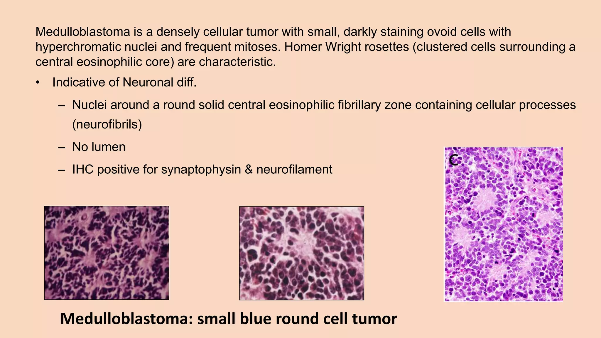 Medulloblastoma | PPTX