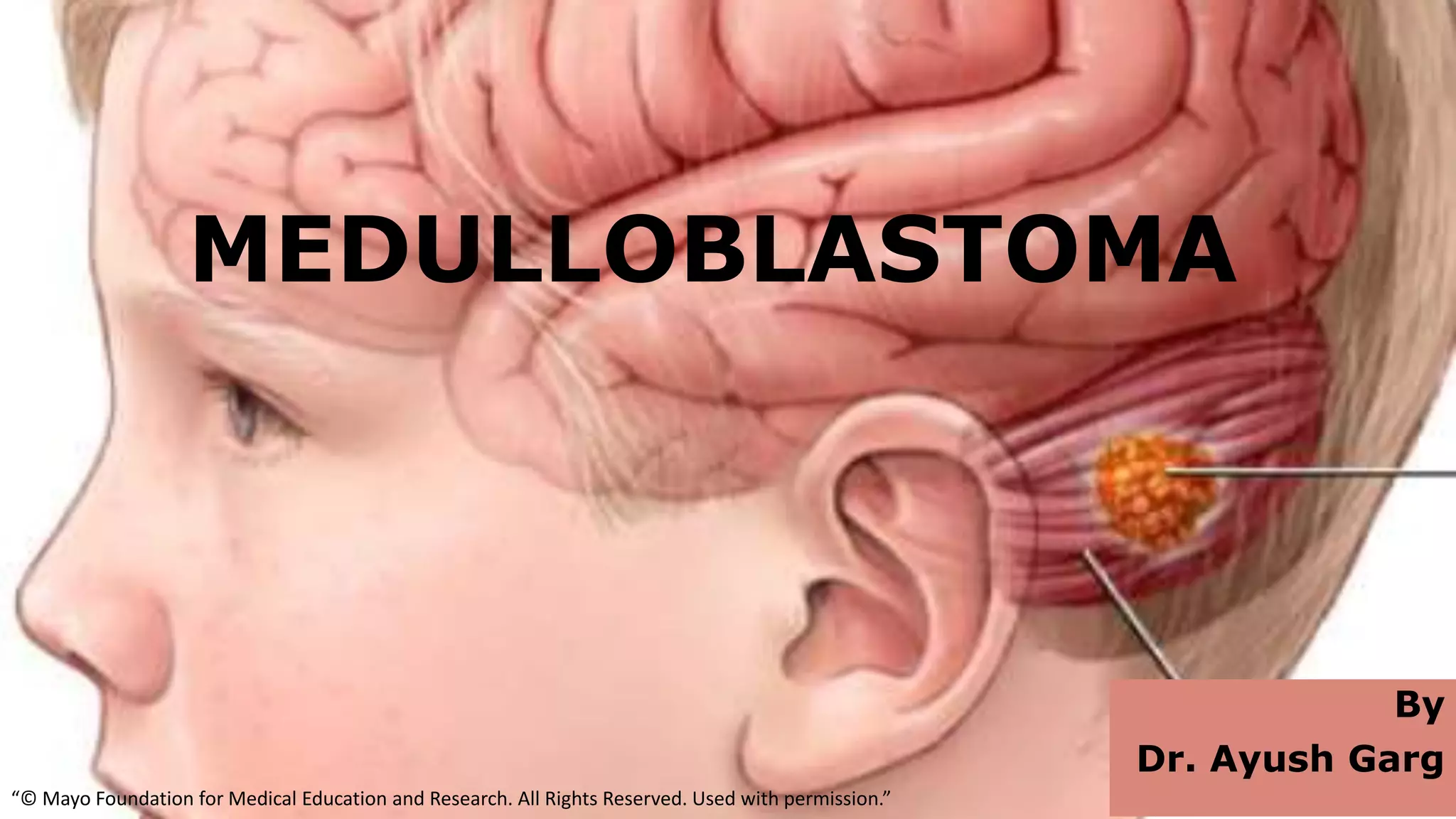 Understanding Medulloblastoma: Classification, Diagnosis and Management | PPT