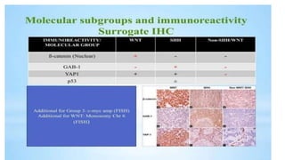 Medulloblastoma : clinical staging, molecular stratification and ...