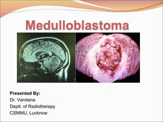 Medulloblastoma