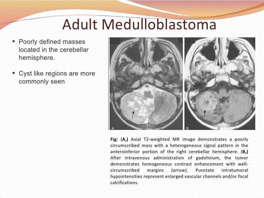 Diagnosis, Treatment & Management of Medulloblastoma
