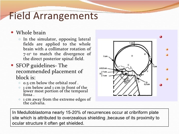Diagnosis, Treatment & Management of Medulloblastoma
