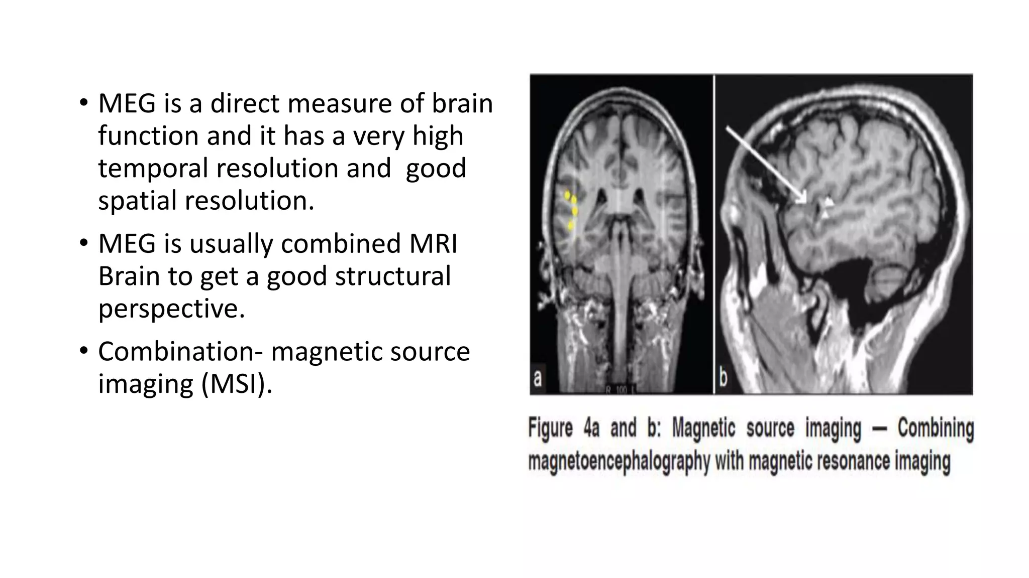 Magnetoencephalography | PPTX
