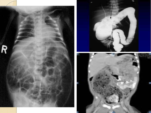 Megacolon Disease in Children | PPTX | Digestive Disorders | Diseases ...