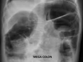 MEGACOLON.pptx